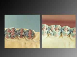 2.wax pattern by lundeen | PPT