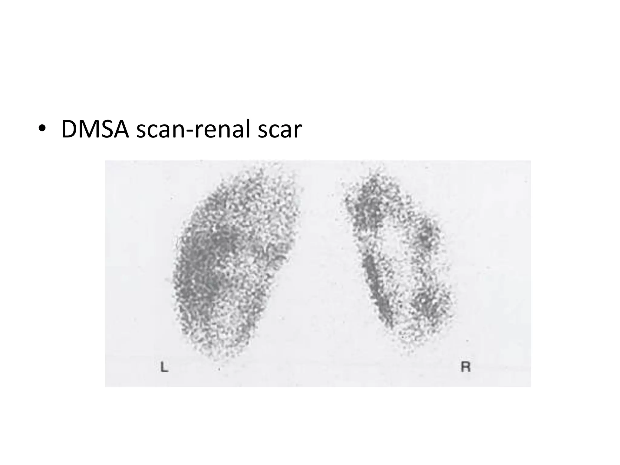 2.hydronephrosis, vur,rcc | PPTX