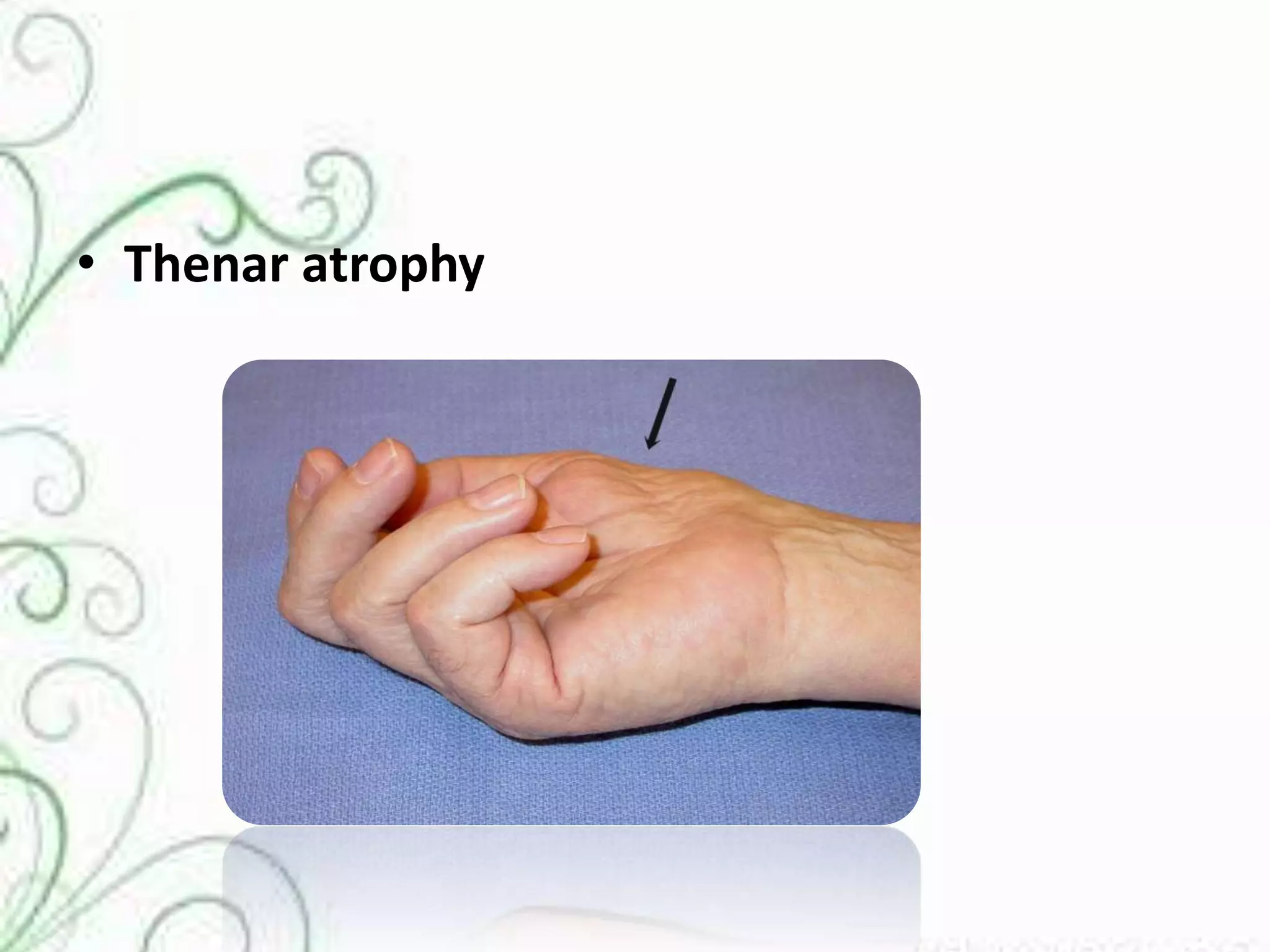 musculoskeletal Disorders | PPTX