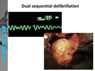 Current controversies in resuscitation | PPT