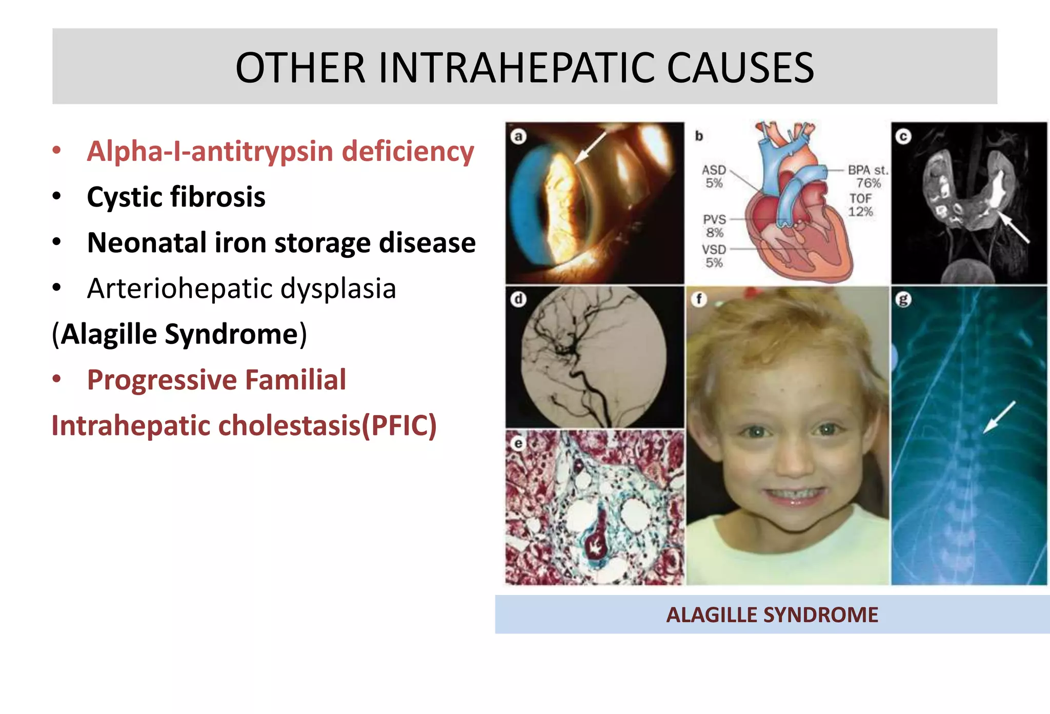 Neonatal Cholestasis | PPTX