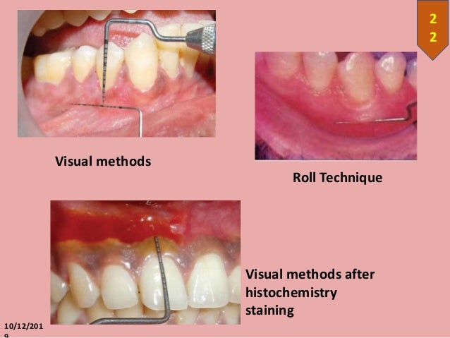 2. gingiva