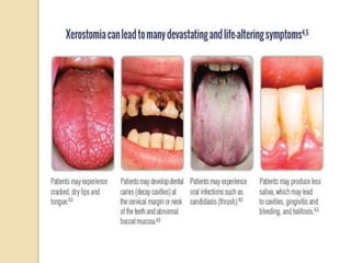 SALIVARY GLAND DISORDER AND XEROSTOMIA | PPTX