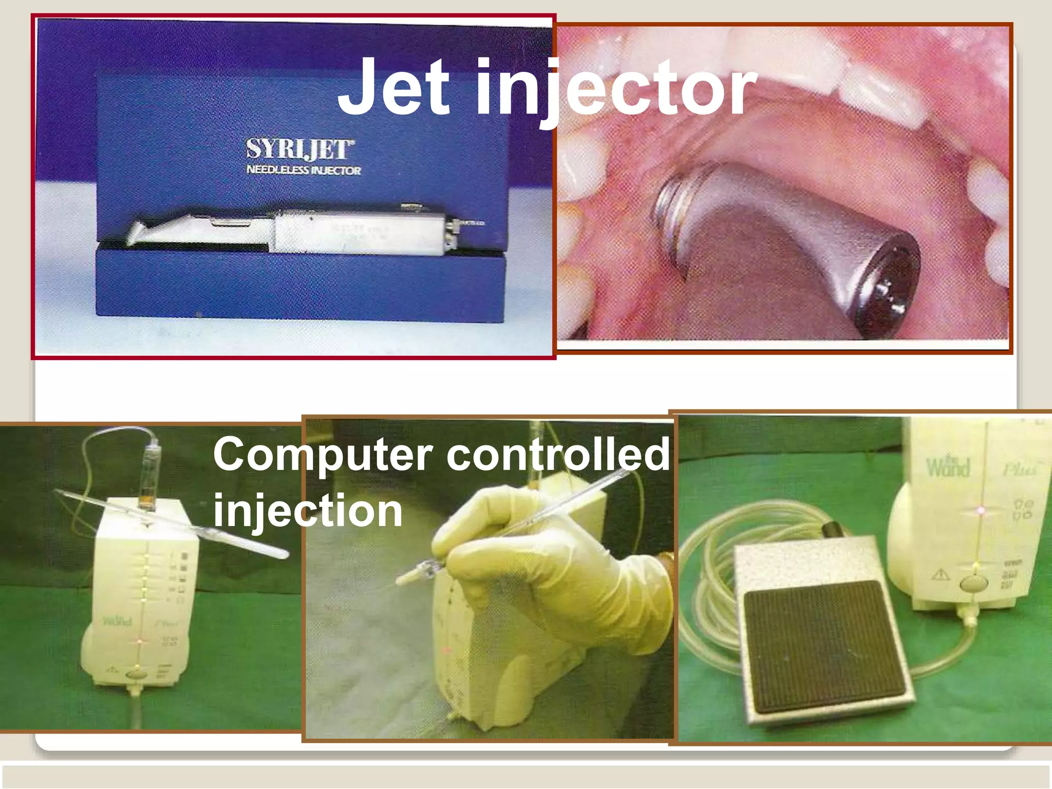 local anesthesia | PPT
