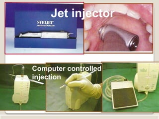 local anesthesia | PPT