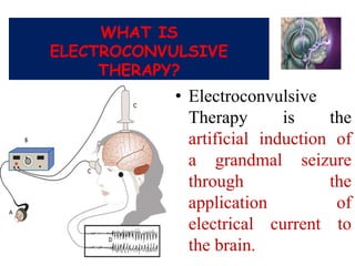 Electroconvulsive Therapy Diagram