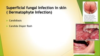 2.5 antimicrobial agents( anti fungal) | PDF