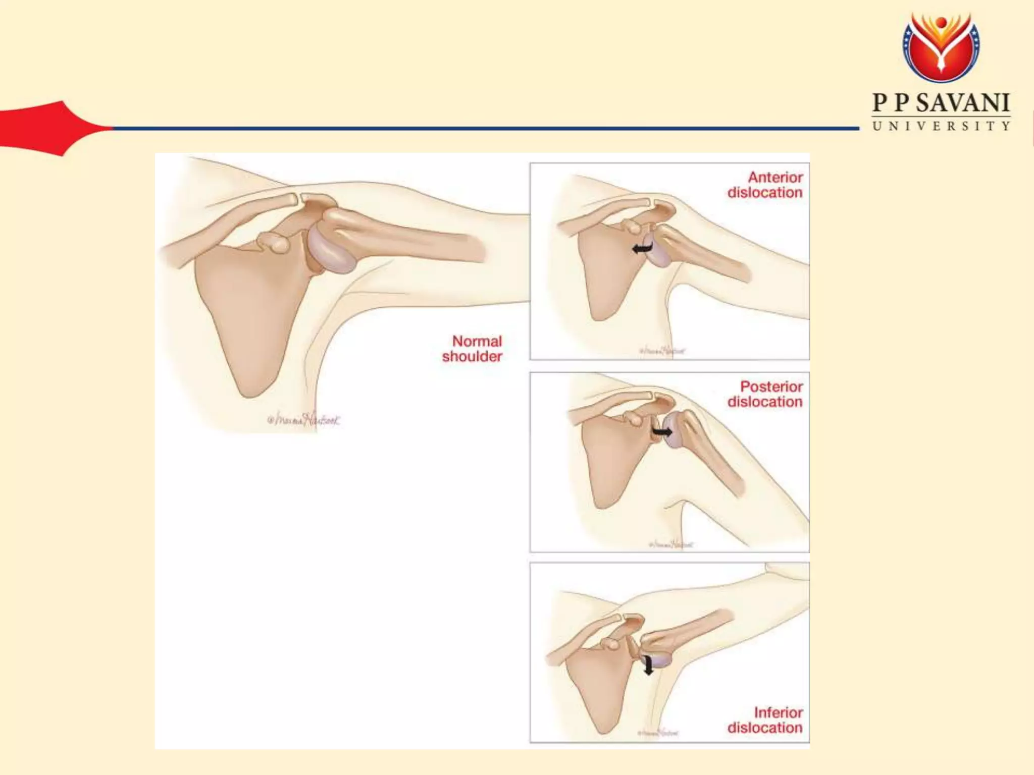 2. Dislocation of Shoulder | PPTX