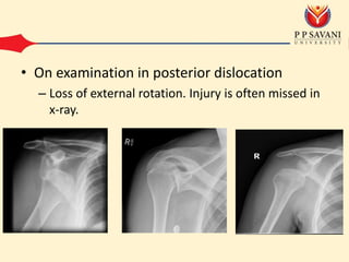 2. Dislocation of Shoulder | PPTX