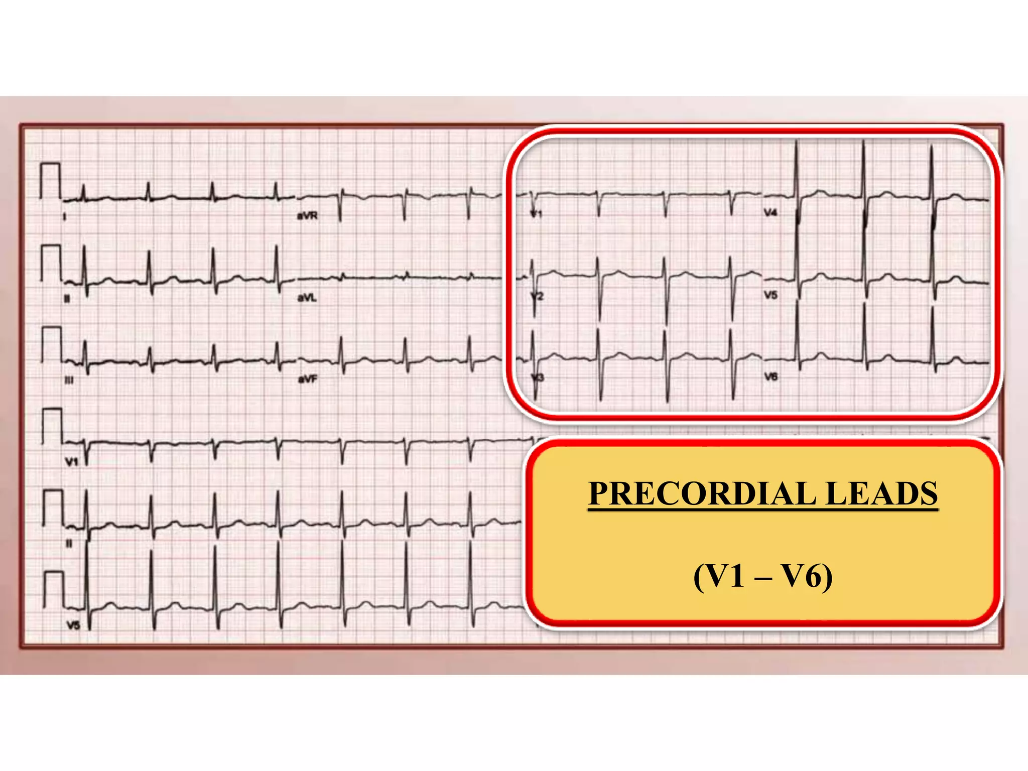 2. ecg basics leads | PPT