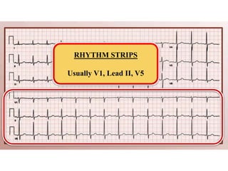 2. ecg basics leads | PPT