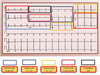 2. ecg basics leads | PPT