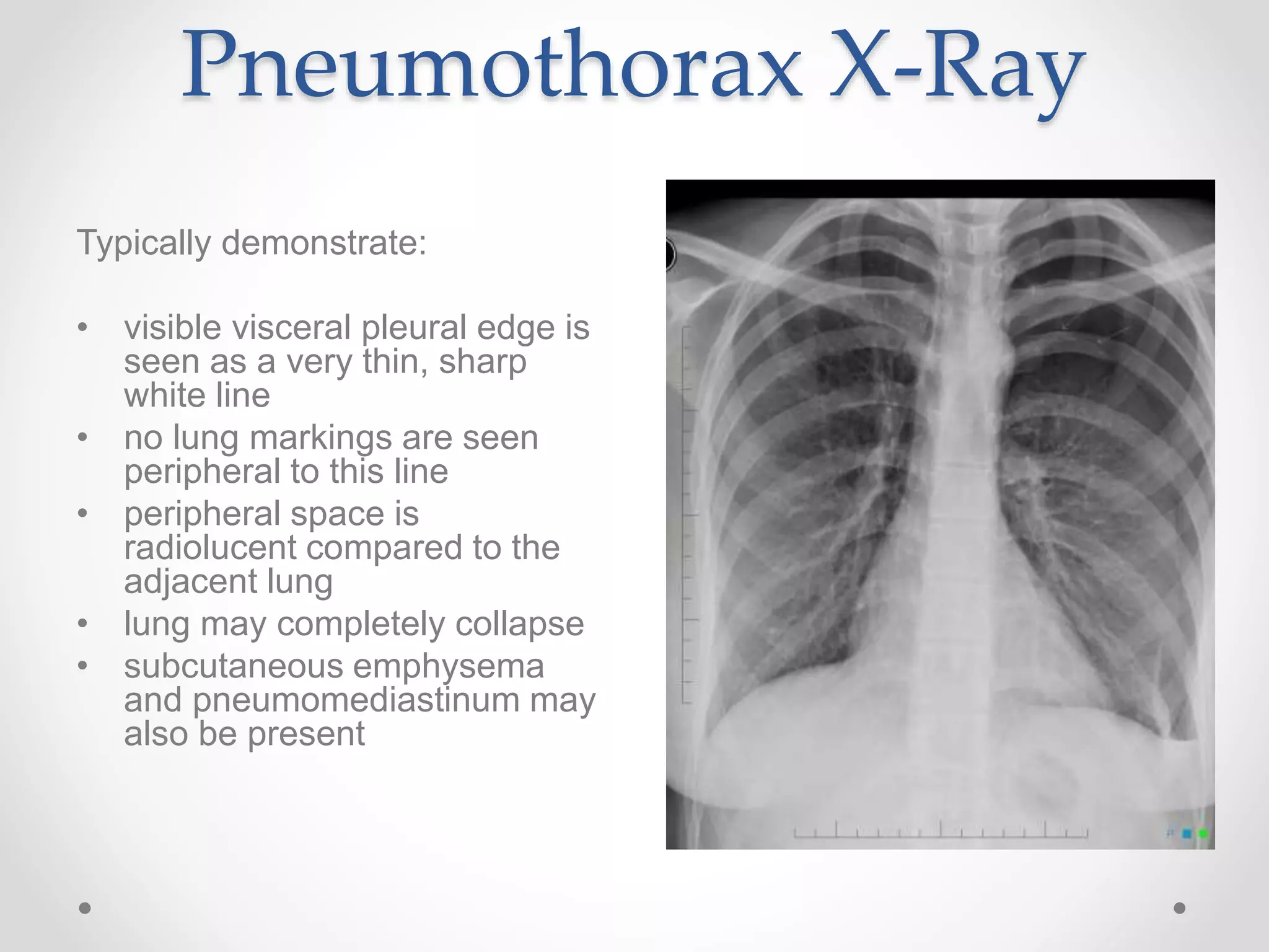 pneumothorax | PPTX