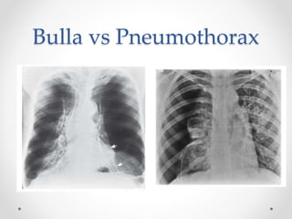 pneumothorax | PPTX | Lung and Respiratory Health | Diseases and Conditions