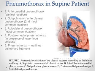 pneumothorax | PPTX