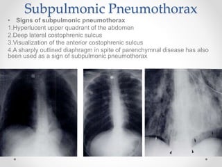 pneumothorax | PPTX