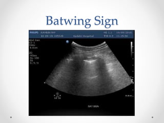 pneumothorax | PPTX | Lung and Respiratory Health | Diseases and Conditions