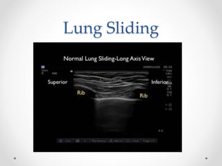 pneumothorax | PPTX
