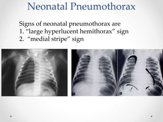 pneumothorax | PPTX | Lung and Respiratory Health | Diseases and Conditions