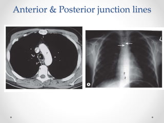 pneumothorax | PPTX