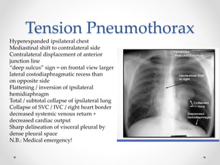 pneumothorax | PPTX