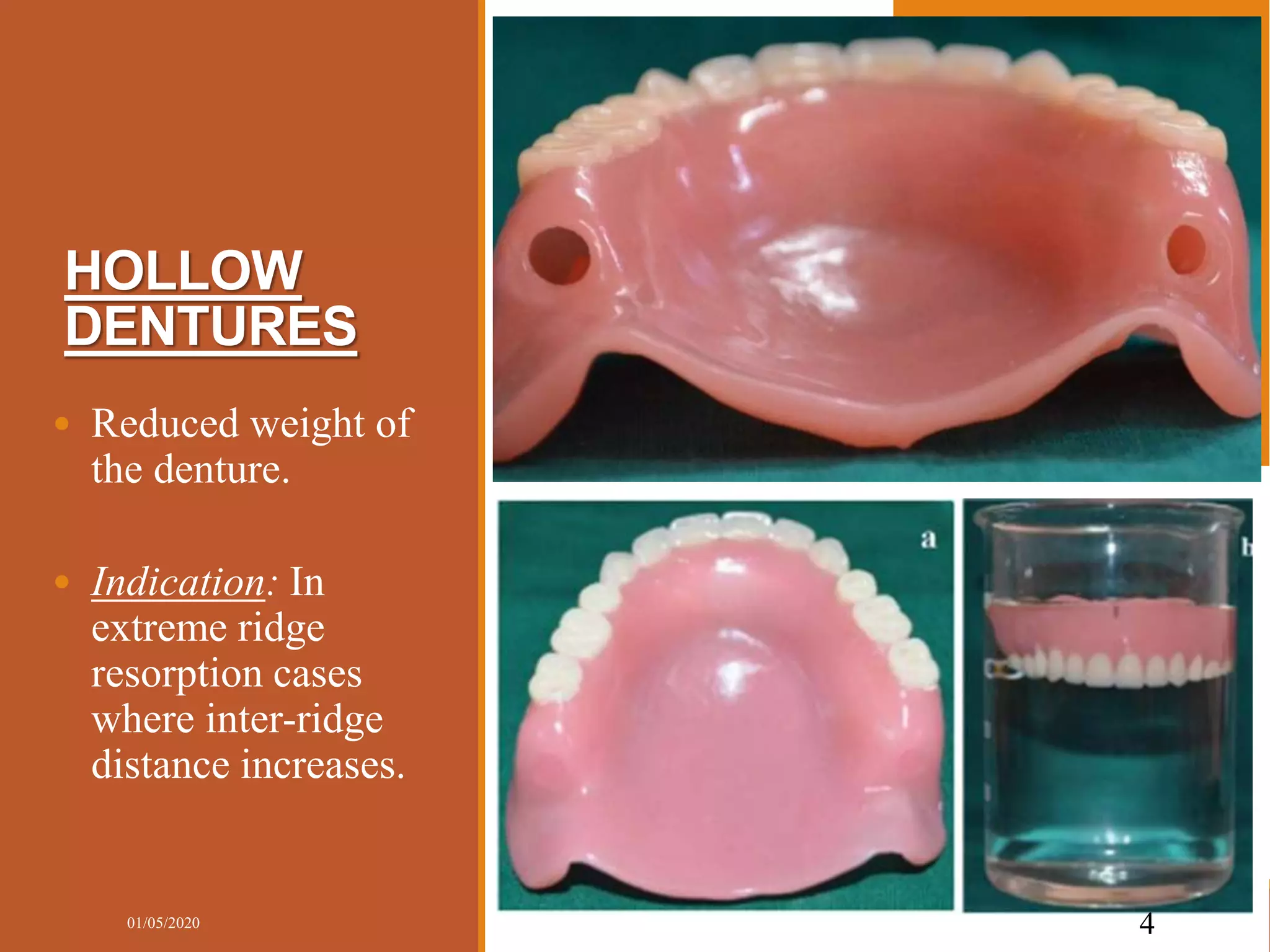 special/ unconventional dentures | PPTX