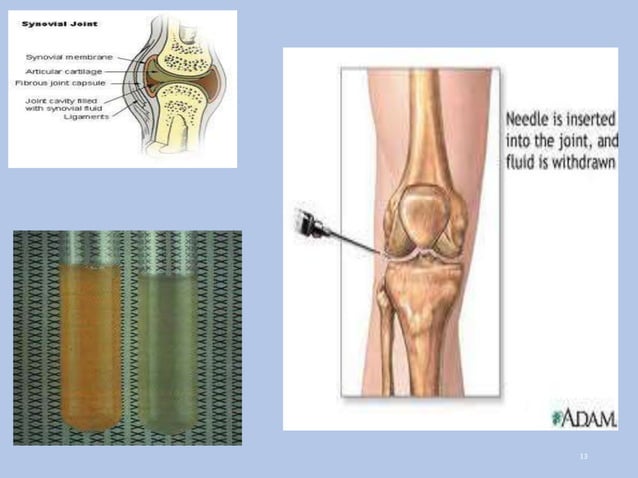 Gout - types,causes,treatment | PPT | Foot Health | Diseases and Conditions