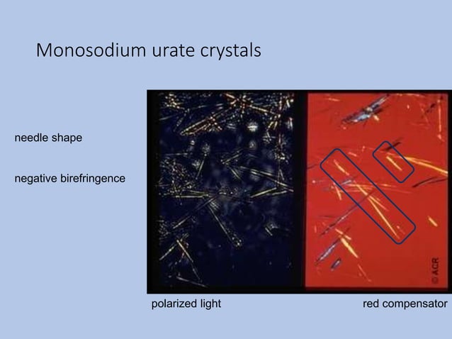 Gout - types,causes,treatment | PPT | Foot Health | Diseases and Conditions