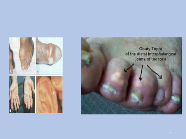 Gout - types,causes,treatment | PPT | Foot Health | Diseases and Conditions