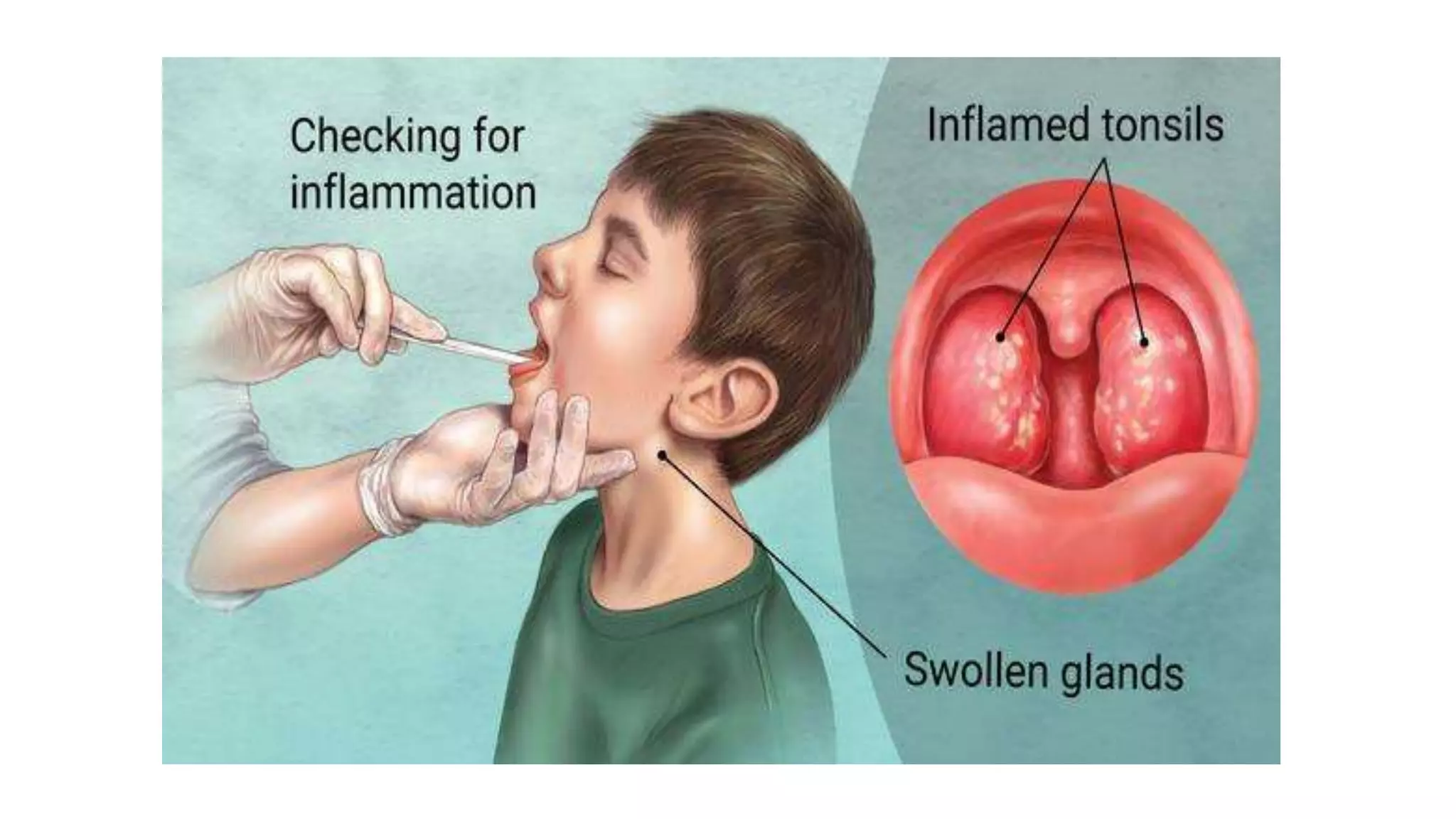 a case study on tonsillitis | PPTX