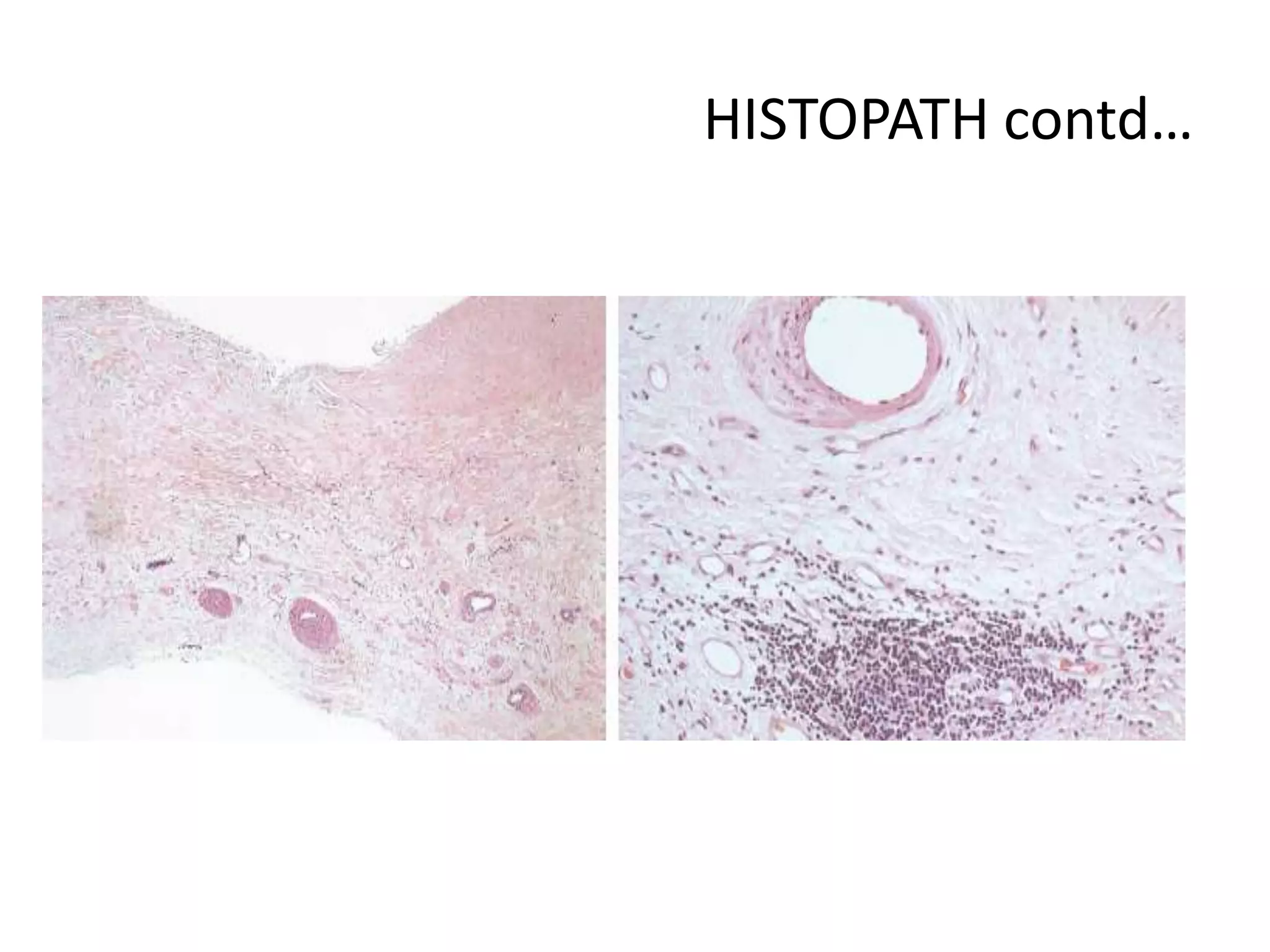 Mitral valve pathophysiology | PPTX | Heart and Cardiovascular Diseases ...