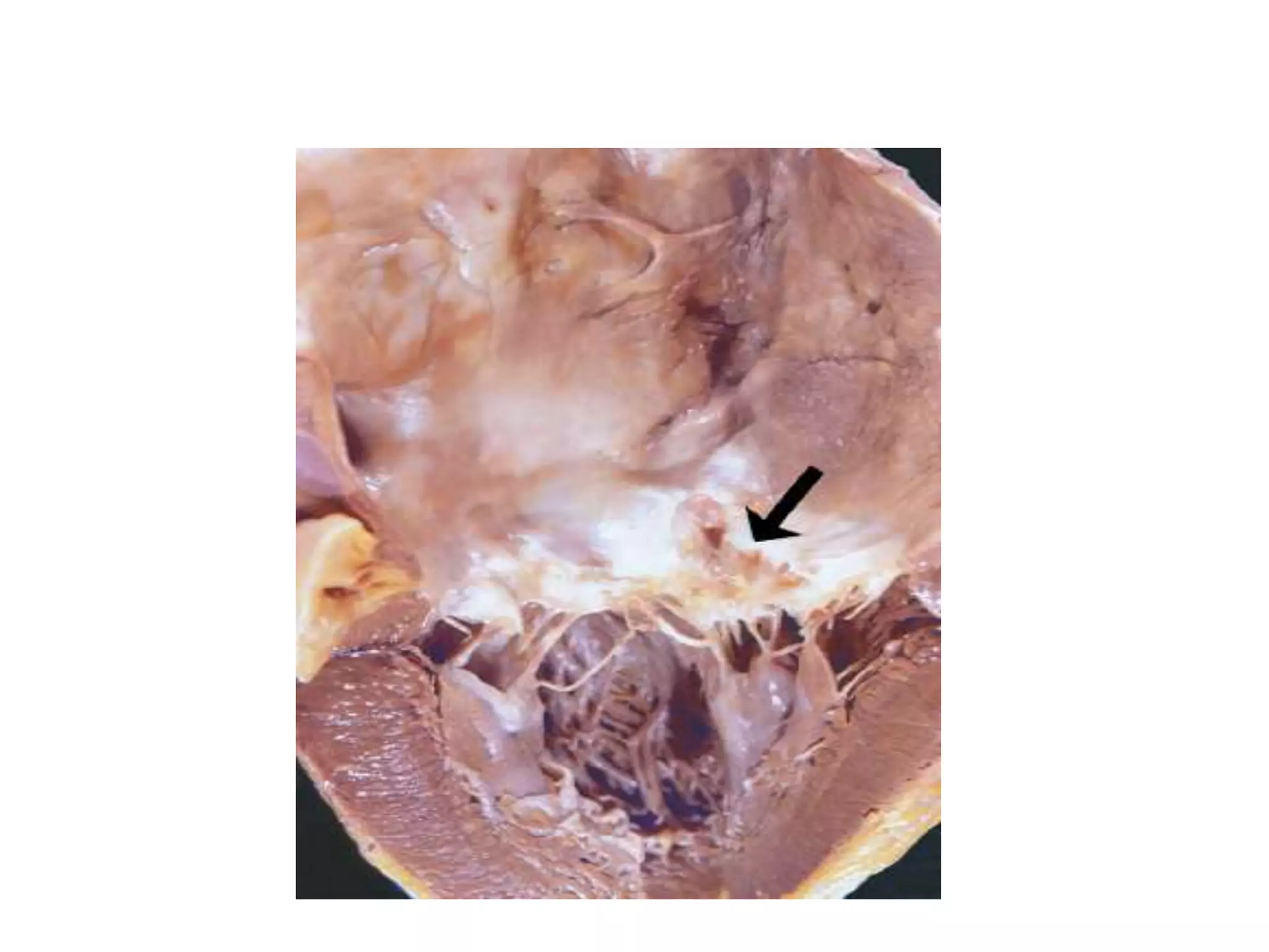 Mitral valve pathophysiology | PPTX | Heart and Cardiovascular Diseases ...