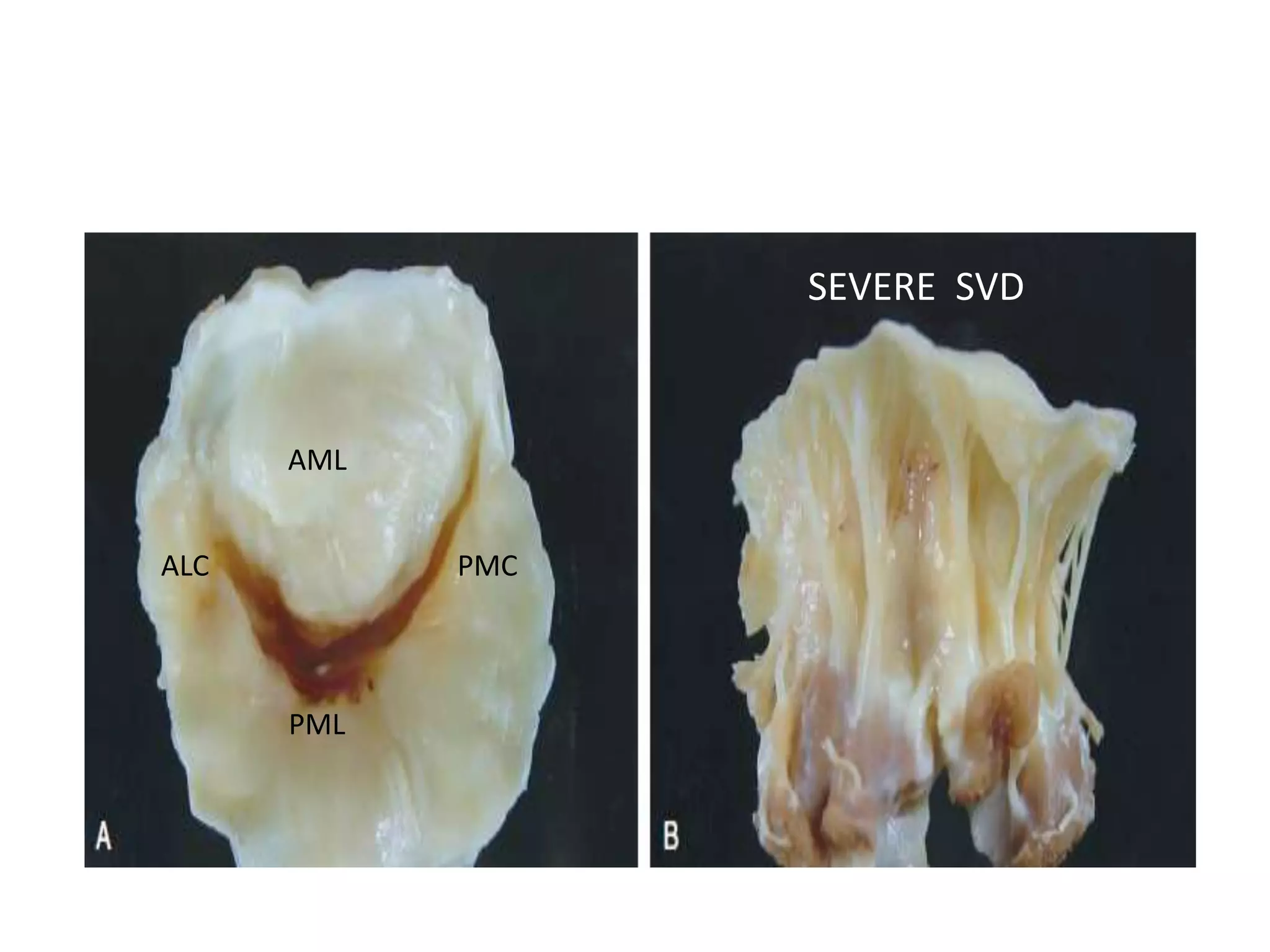 Mitral valve pathophysiology | PPTX | Heart and Cardiovascular Diseases ...