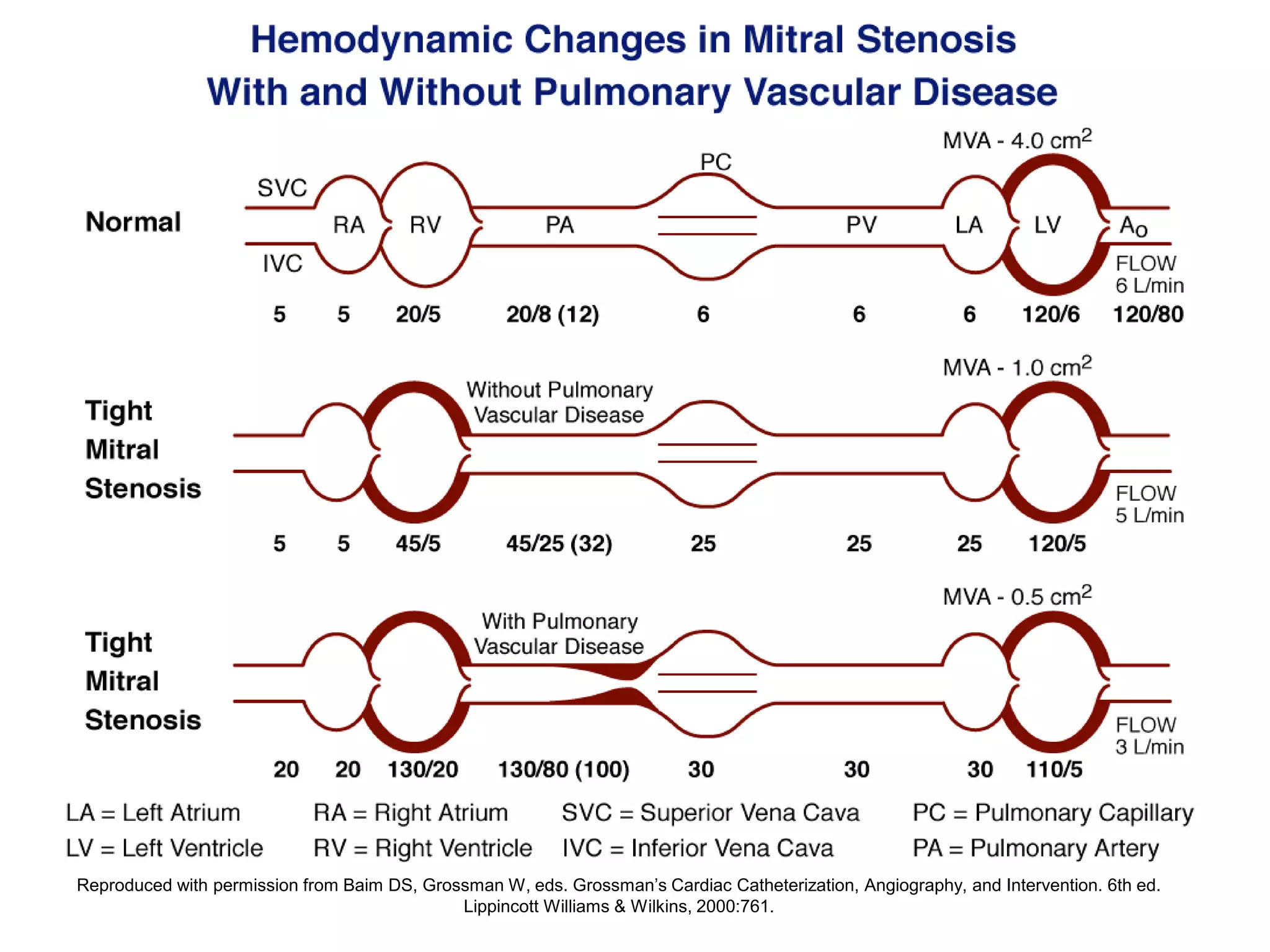 Mitral valve pathophysiology | PPTX
