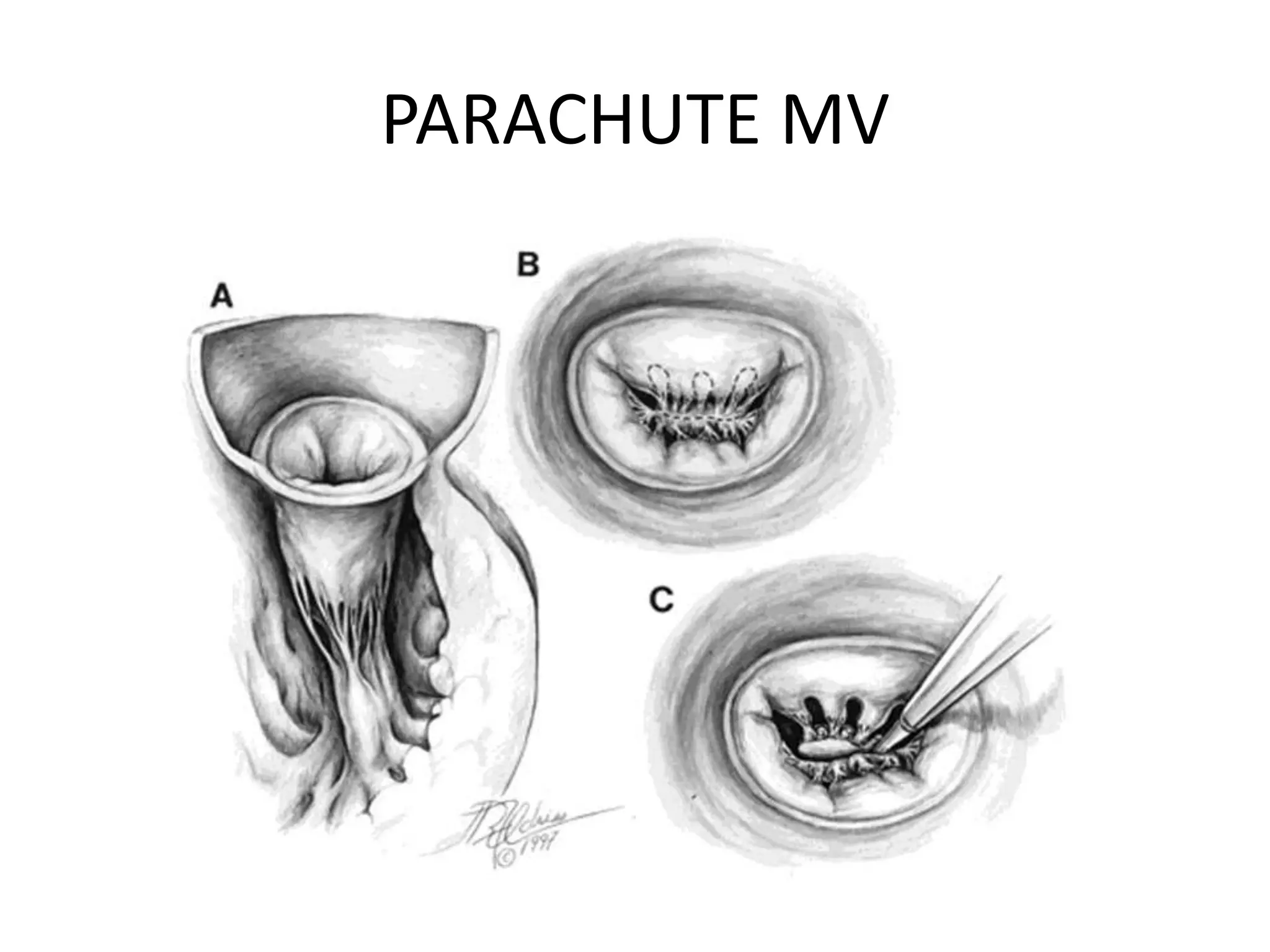 Mitral valve pathophysiology | PPTX | Heart and Cardiovascular Diseases ...