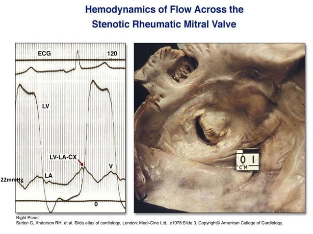 Mitral valve pathophysiology | PPTX | Heart and Cardiovascular Diseases ...