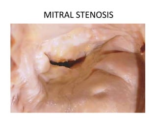 Mitral valve pathophysiology | PPTX