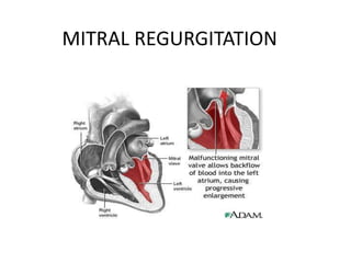 Mitral valve pathophysiology | PPTX