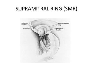 Mitral valve pathophysiology | PPTX