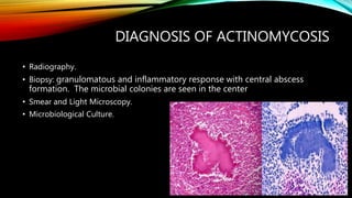 Bacterial Infections of Oral Mucosa | PPTX