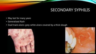 Bacterial Infections Of Oral Mucosa Pptx