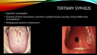 Bacterial Infections of Oral Mucosa | PPTX
