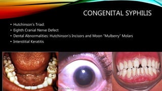 Bacterial Infections of Oral Mucosa | PPTX