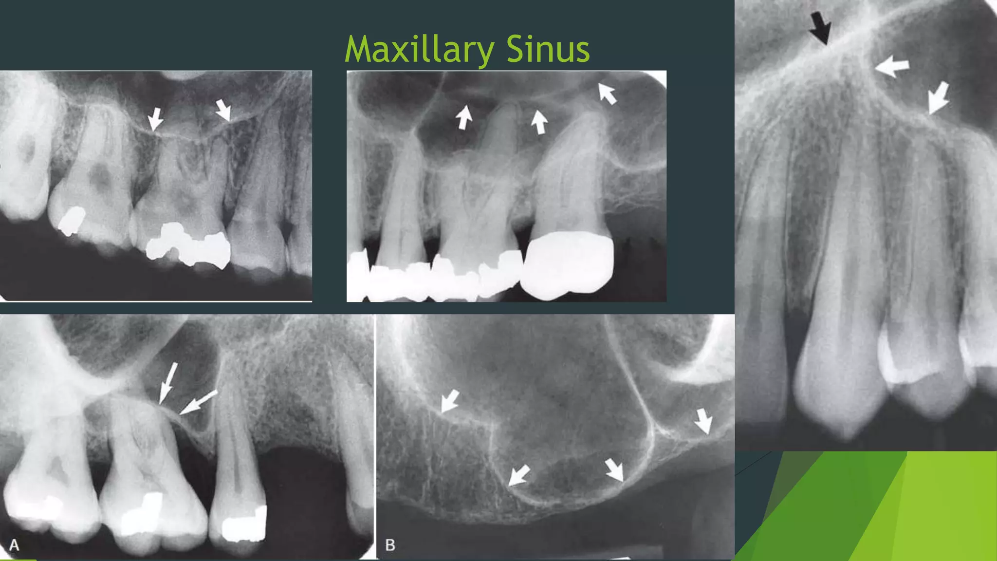 Normal Radiographic Anatomy of Oral Structures | PPTX