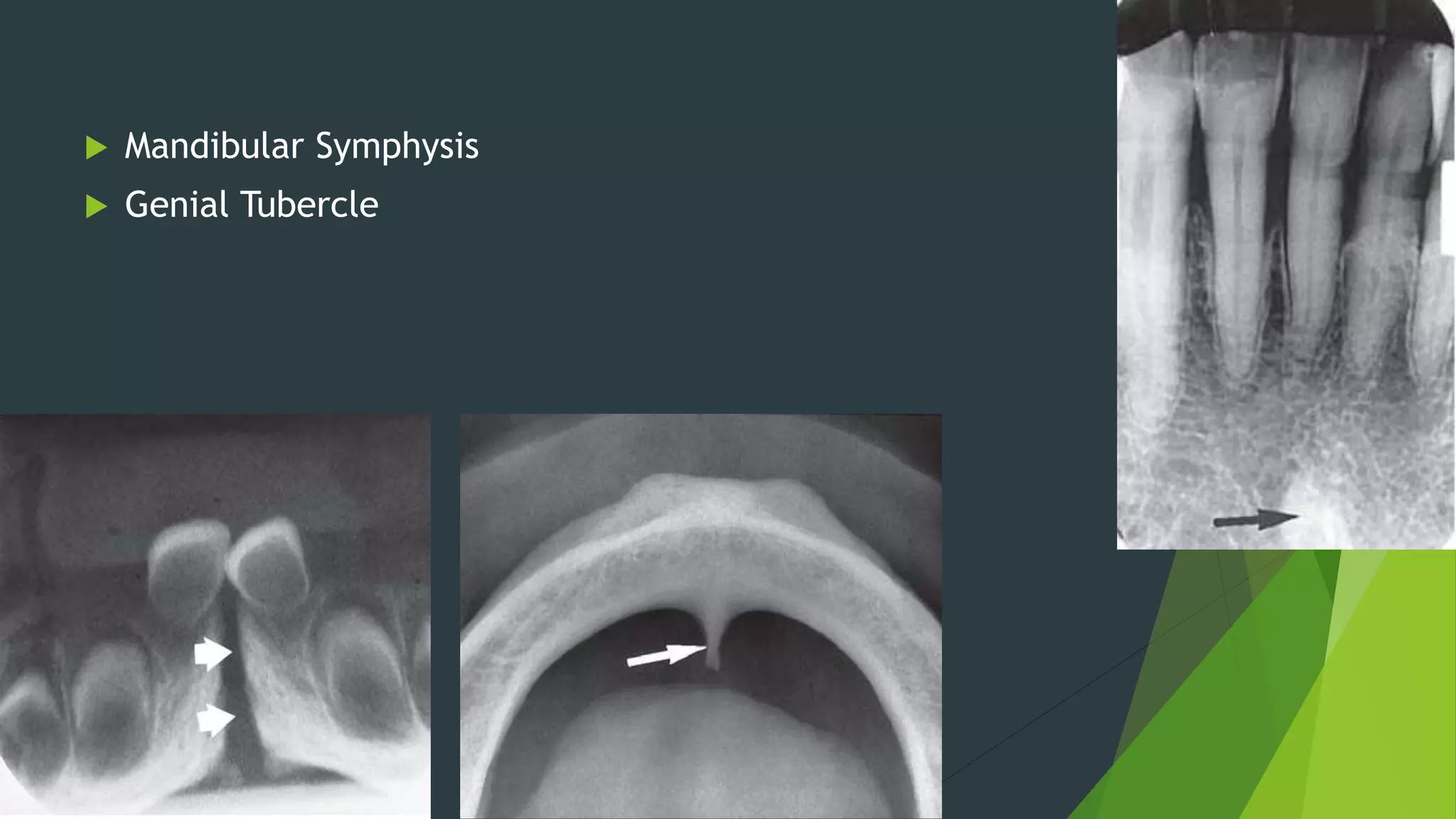 Normal Radiographic Anatomy of Oral Structures | PPTX
