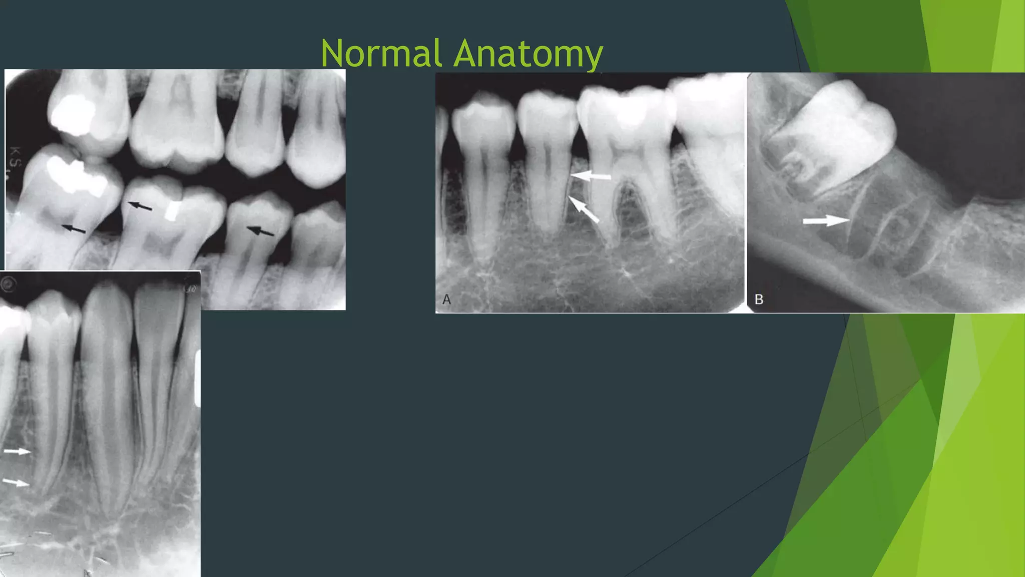 Normal Radiographic Anatomy of Oral Structures | PPTX