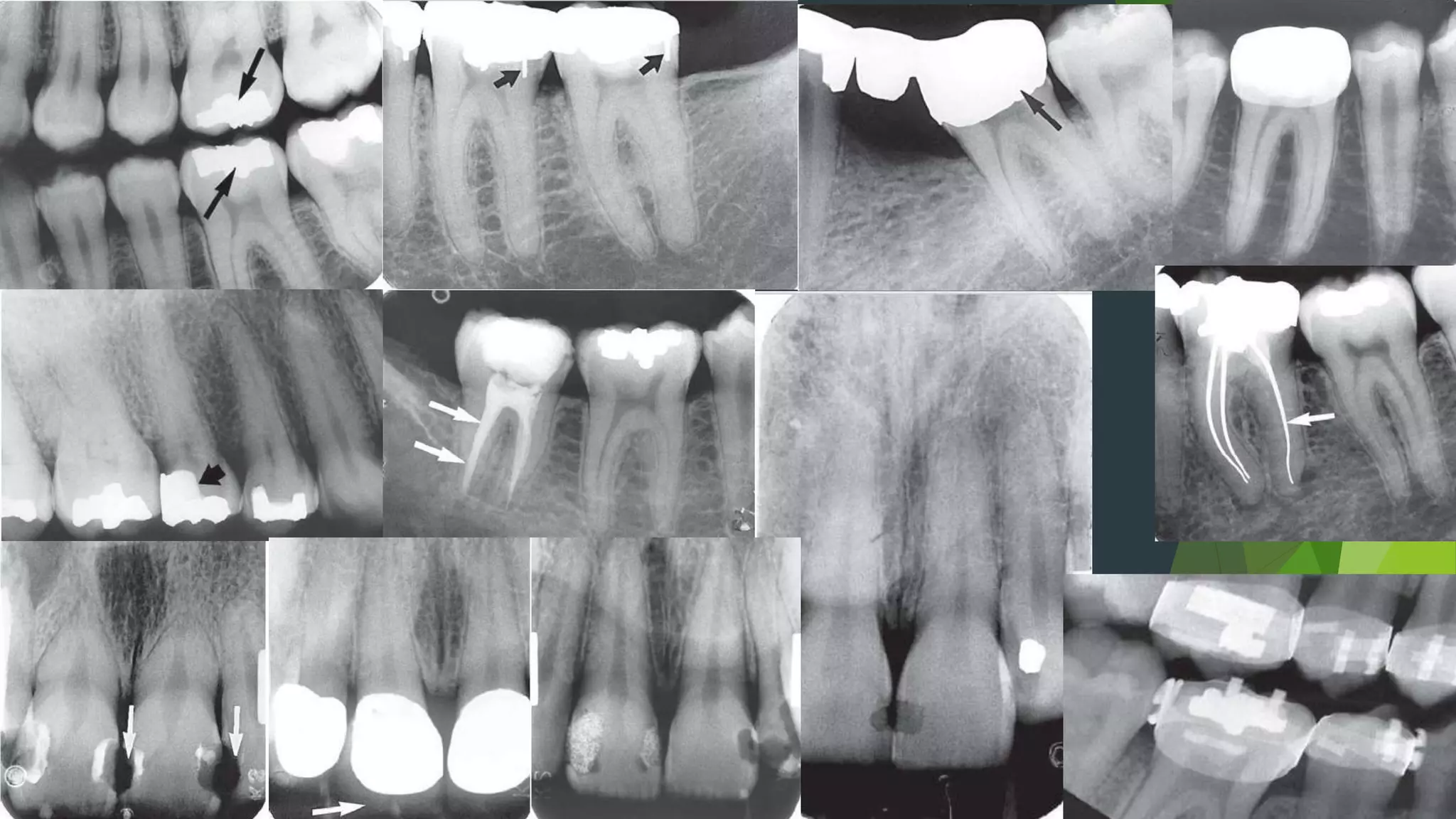 Normal Radiographic Anatomy of Oral Structures | PPTX