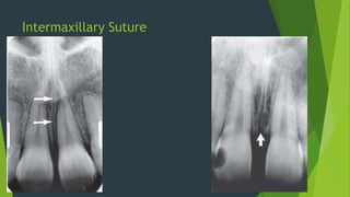 Normal Radiographic Anatomy of Oral Structures | PPTX