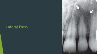 Normal Radiographic Anatomy of Oral Structures | PPT