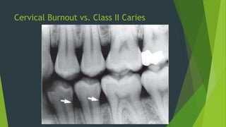 Normal Radiographic Anatomy of Oral Structures | PPT